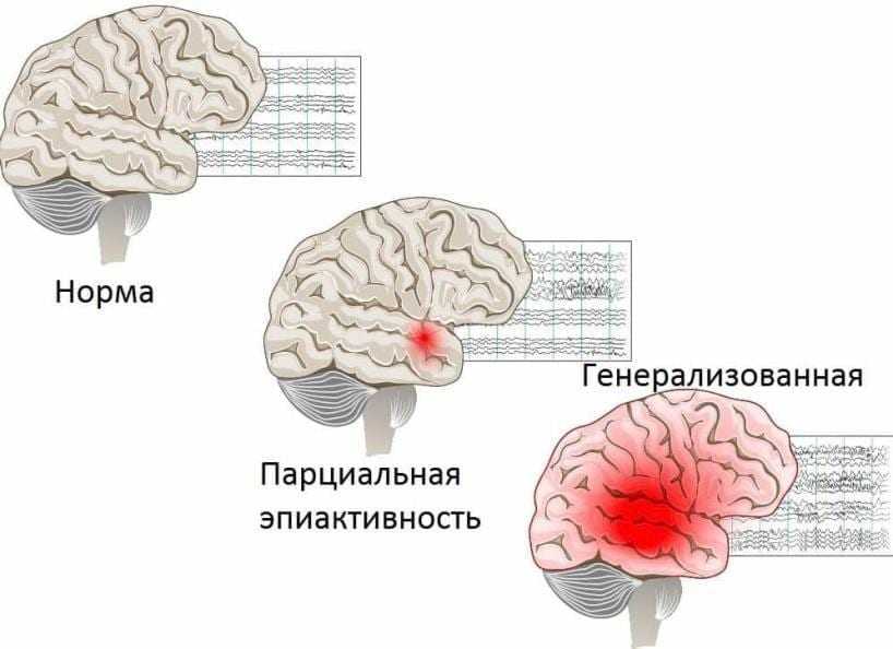 Виды эпилепсии. Формы и типы эпилептических припадков.